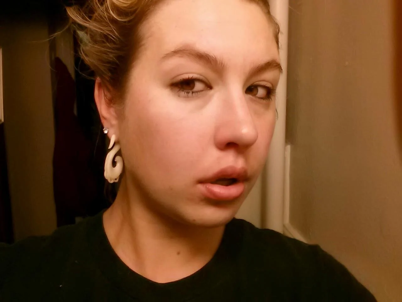 Bulimia Cheeks Before After